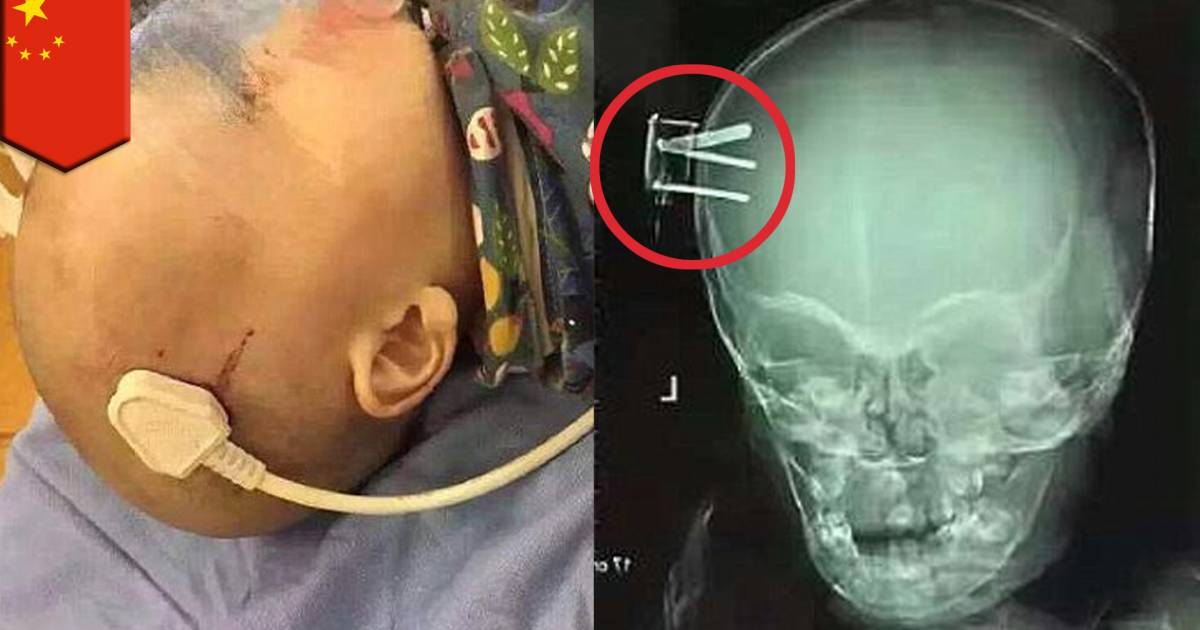 X-ray of boy’s brain injury shocks doctors, serves as warning to all ...